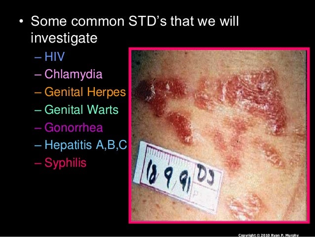 HIV, AIDS, STD's / STI's, Human Immunodeficiency Virus, Acquired Immu…