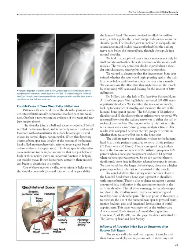 Snapping Scapula Syndrome | Medial Knee Reconstruction | Hip ...