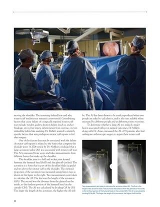 Snapping Scapula Syndrome | Medial Knee Reconstruction | Hip ...