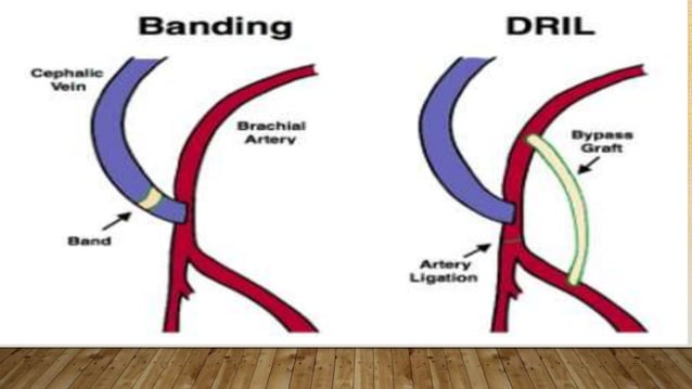 STEAL SYNDROME.pptx | Brain and Nervous System Disorders | Diseases and ...