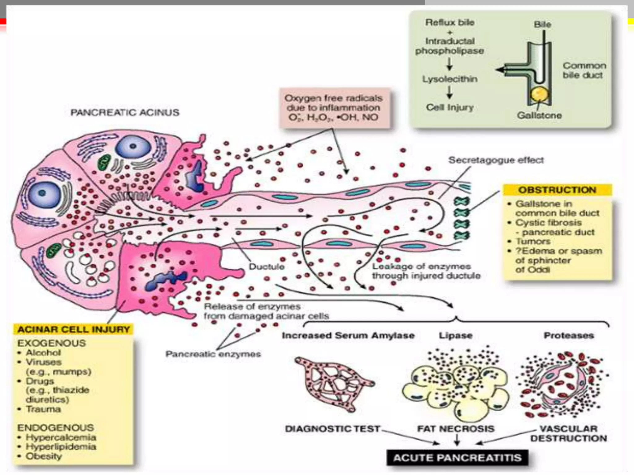 Steatorrhea, Chyluria, Gallstone (Cholelithiasis), Pancreatitis ...