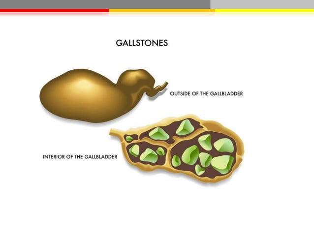 Steatorrhea, Chyluria, Gallstone (Cholelithiasis), Pancreatitis ...