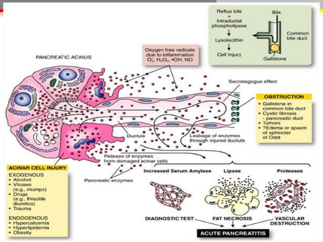 Steatorrhea, Chyluria, Gallstone (Cholelithiasis), Pancreatitis ...