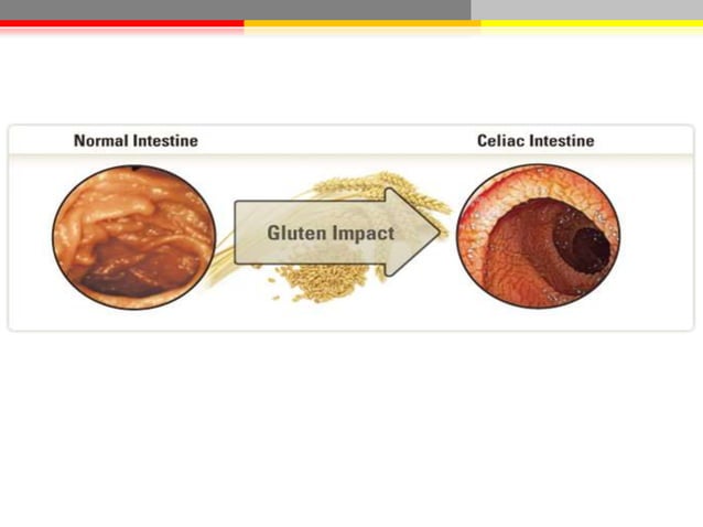 Steatorrhea, Chyluria, Gallstone (Cholelithiasis), Pancreatitis ...
