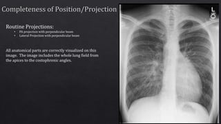 Kristen Steever PA Chest | PPTX