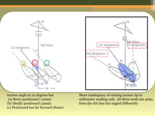 STEINERS ANALYSIS : CEPHALOMETRICS | PPTX