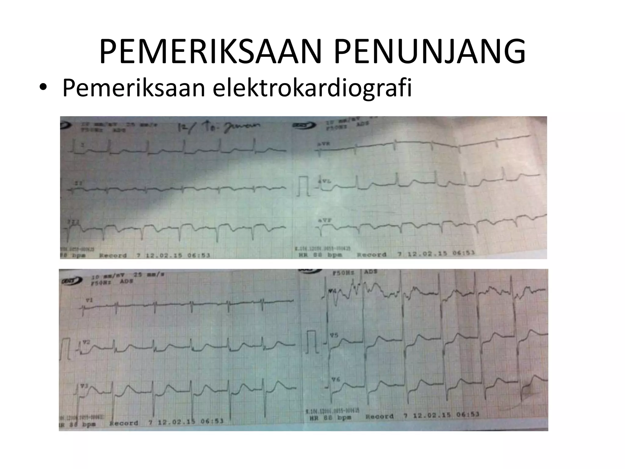 ST ELEVASI MIOKARD INFARK INFERIOR.pptx
