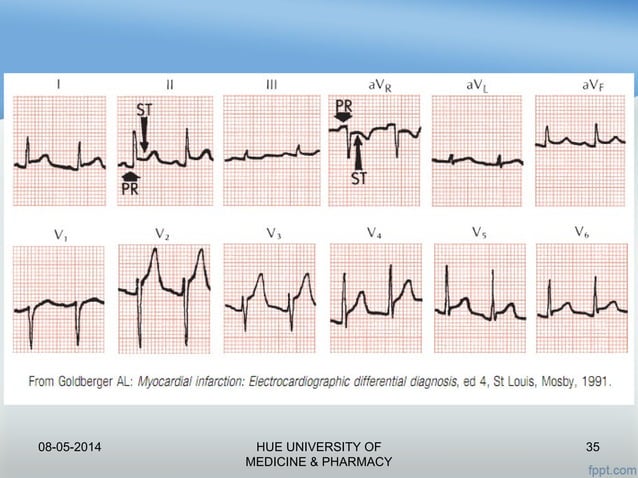 ST elevation | PPT