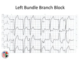 St elevation myocardial infarction | PPT