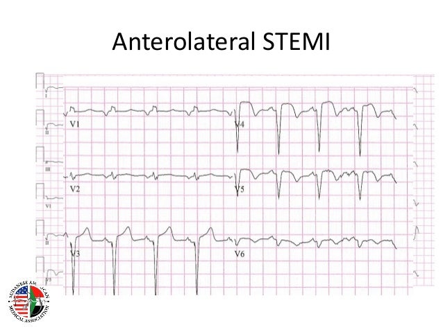 St elevation myocardial infarction