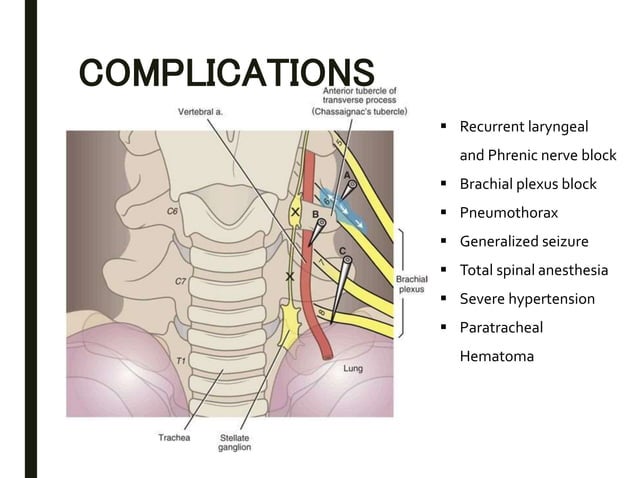 Stellate ganglion block
