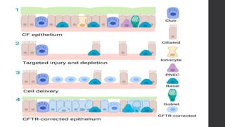 STEM CELL THERAPY FOR CYSTIC FIBROSIS, research updates.pdf