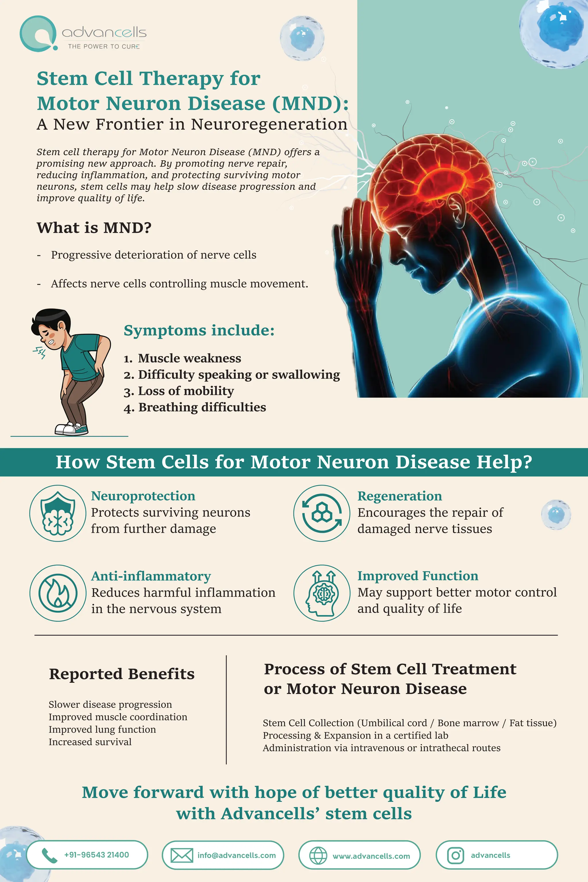 Stem Cell Therapy for Motor Neuron Disease (MND): A New Frontier in ...