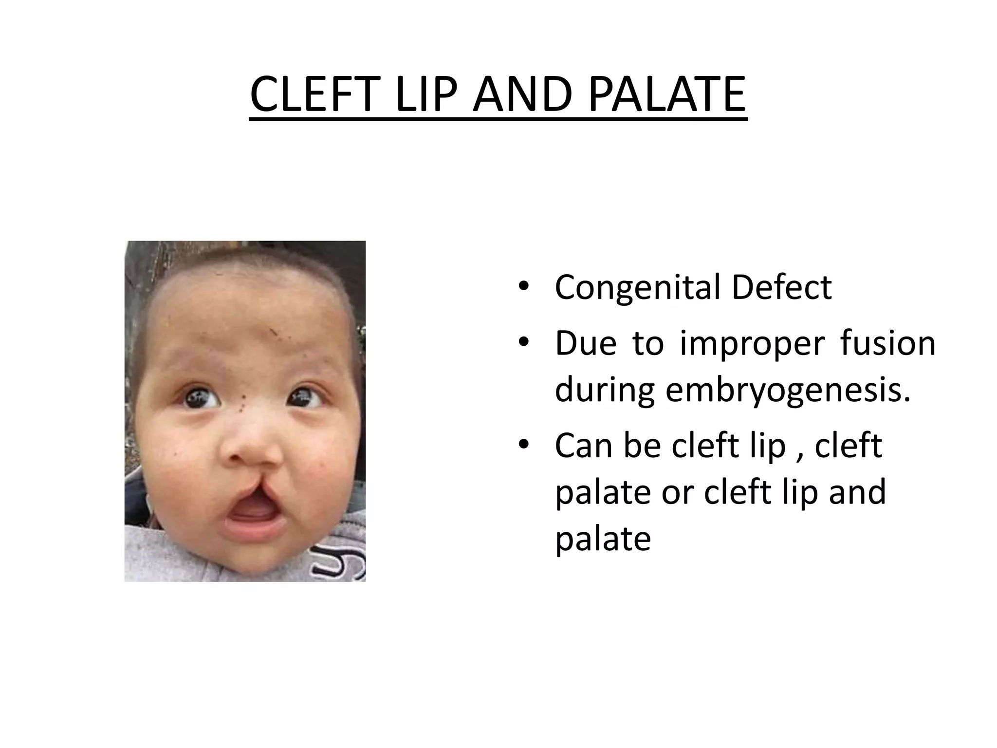 Stem cell therapy in cleft lip and palate | PPTX