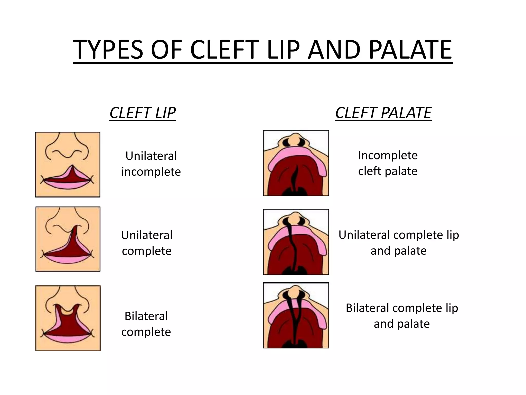 Stem cell therapy in cleft lip and palate | PPTX