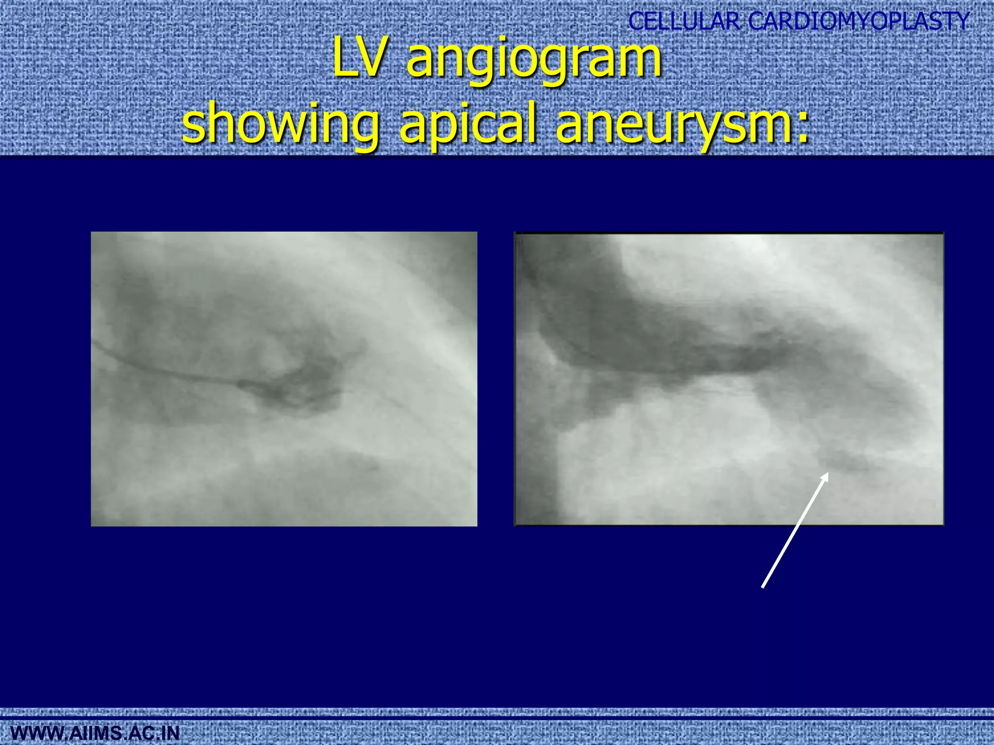 Stem cell transplantation with CABG | PPT