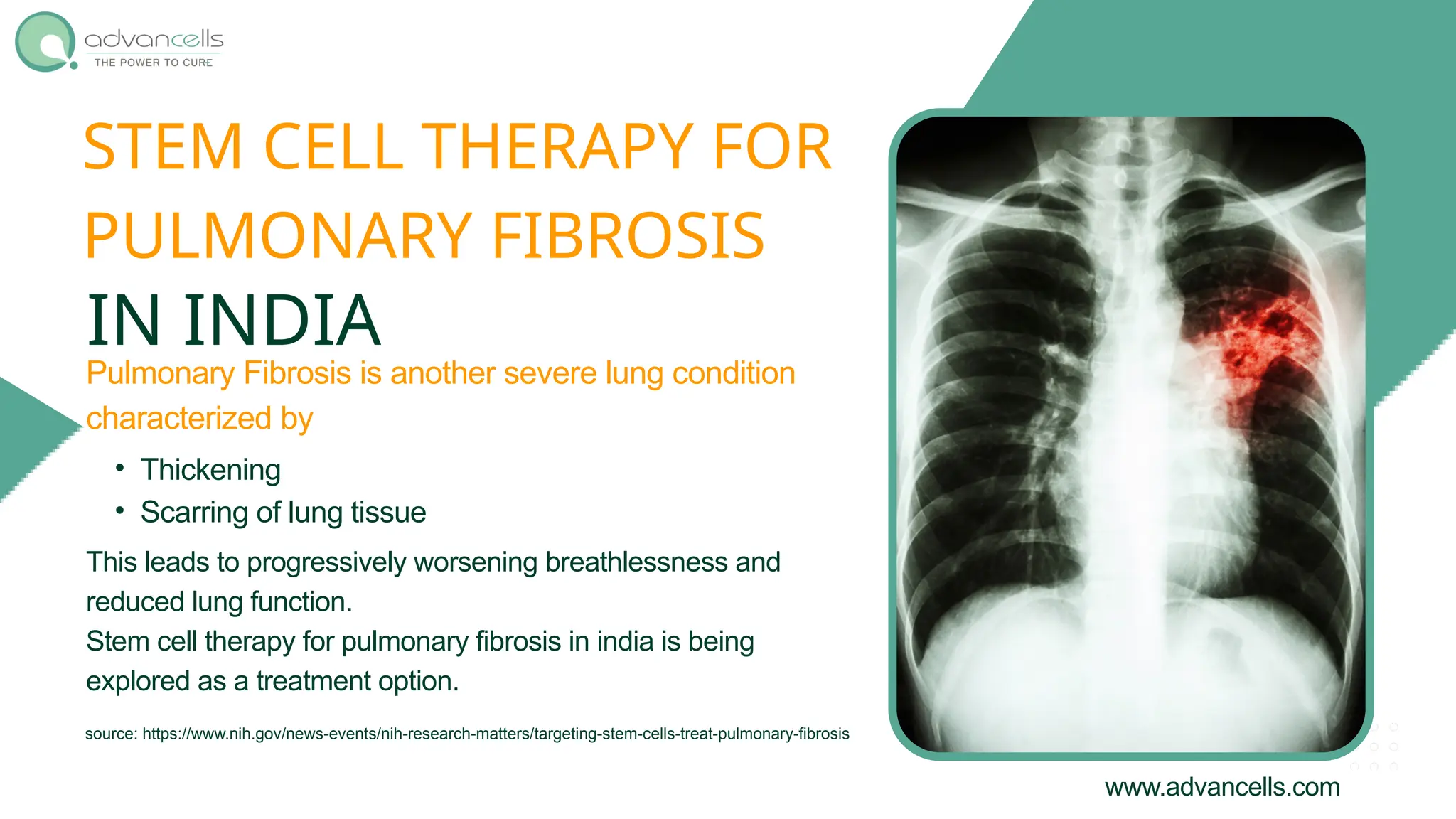 Stem Cell Treatment Options for COPD and Pulmonary Fibrosis in India | PPTX