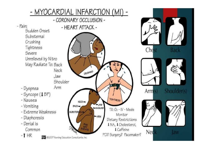 Stemi | PPTX | Heart and Cardiovascular Diseases | Diseases and Conditions