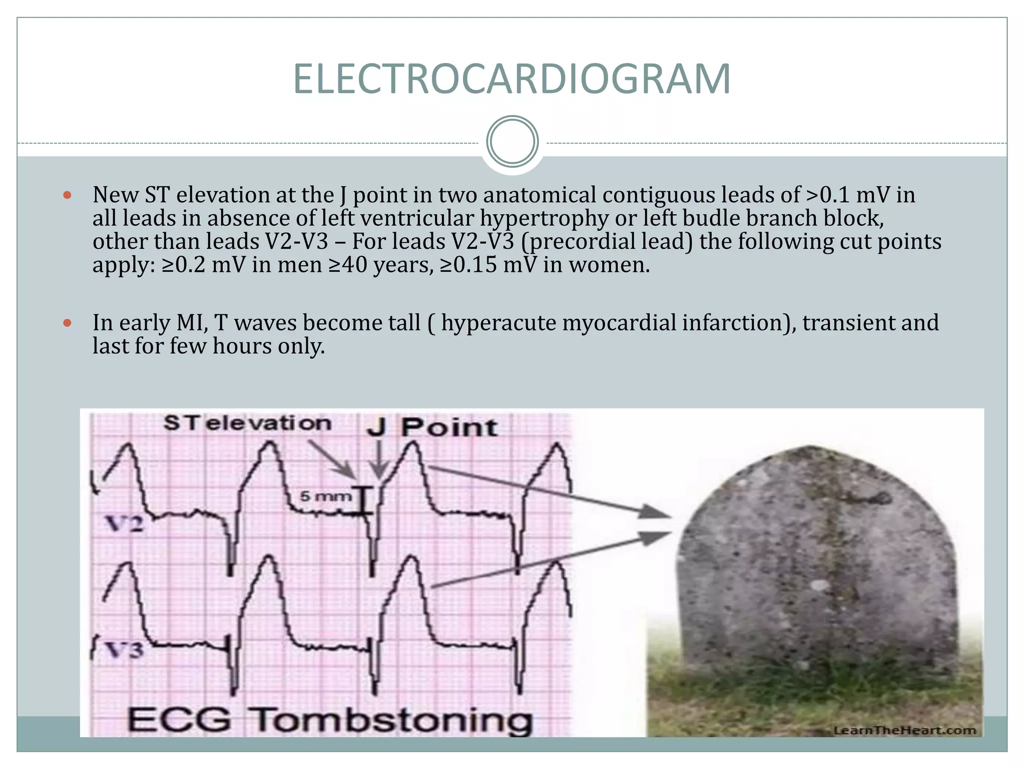 Stemi | PPTX