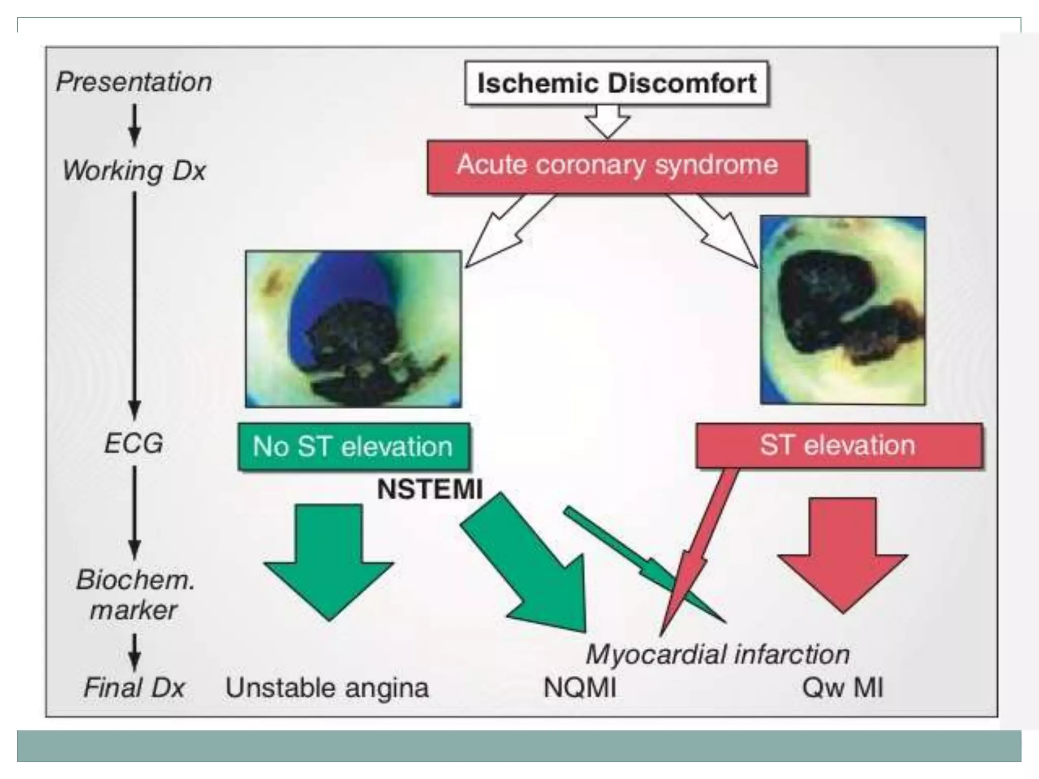 Stemi | PPTX | Heart and Cardiovascular Diseases | Diseases and Conditions