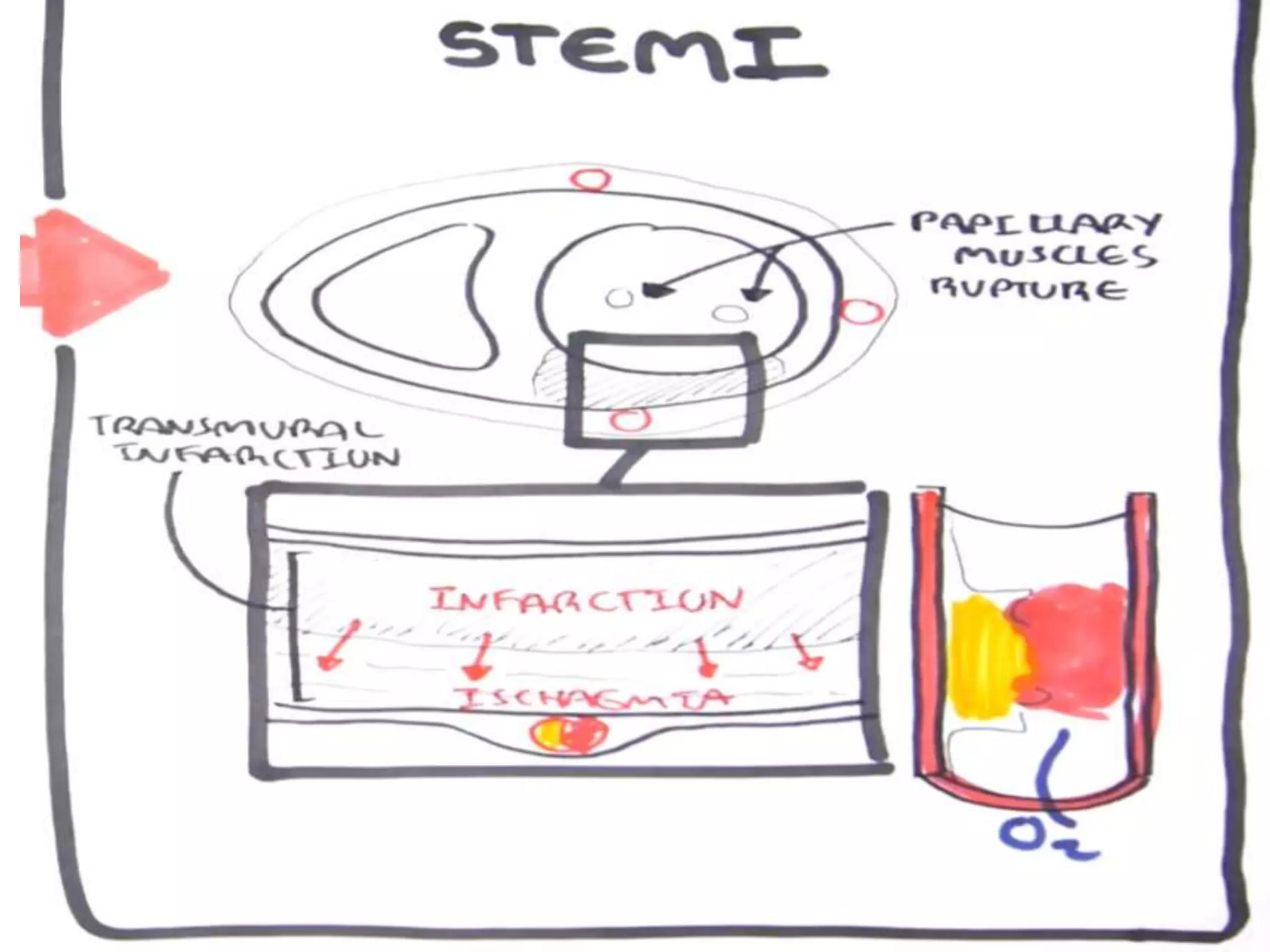 Stemi | PPTX