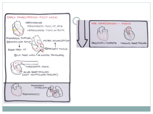 Stemi | PPTX | Heart and Cardiovascular Diseases | Diseases and Conditions