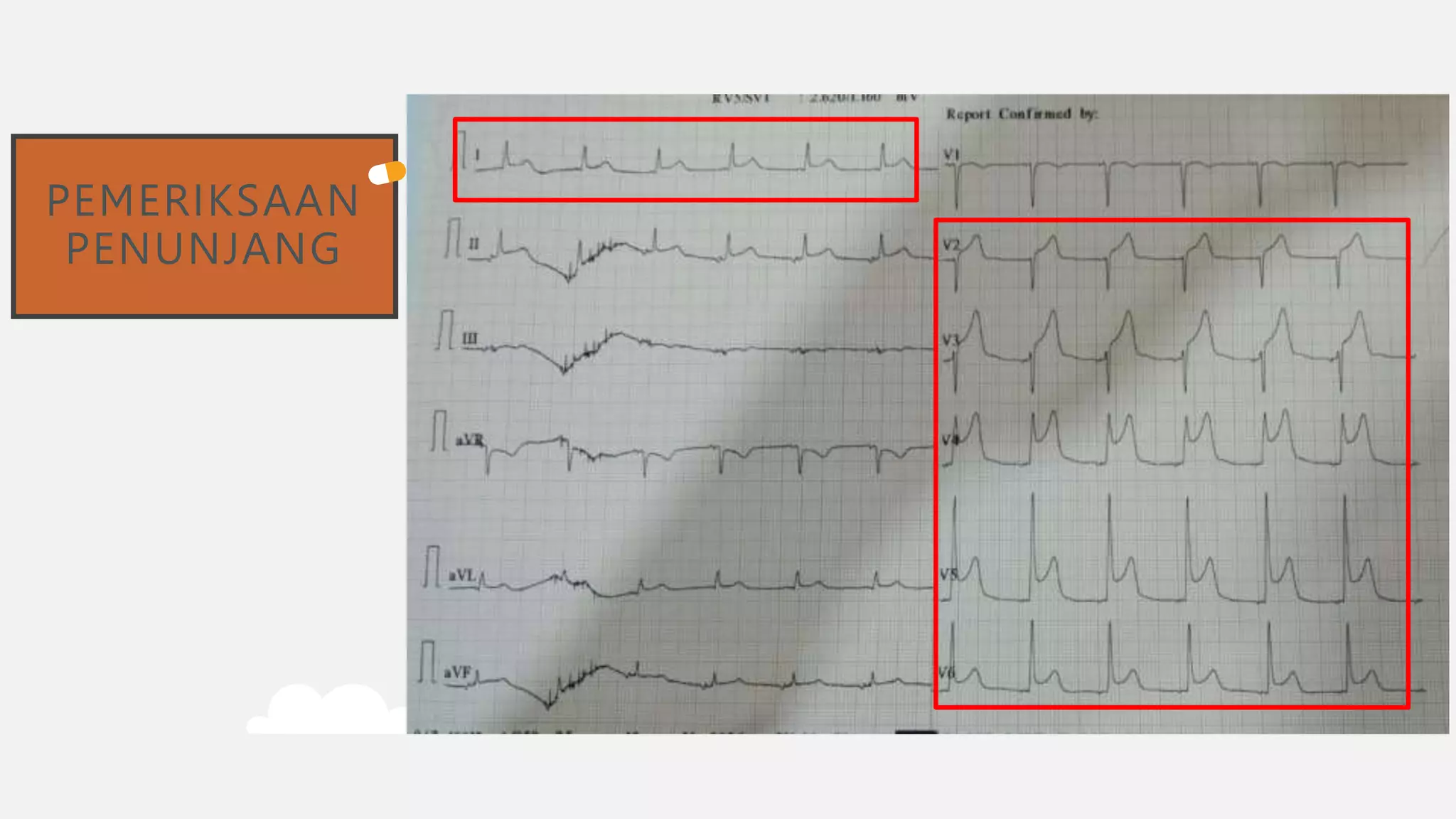 stemi inferior.pptx