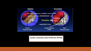 STEMI.pptx