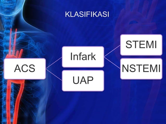 Laporan Kasus ACS STEMI | PPT