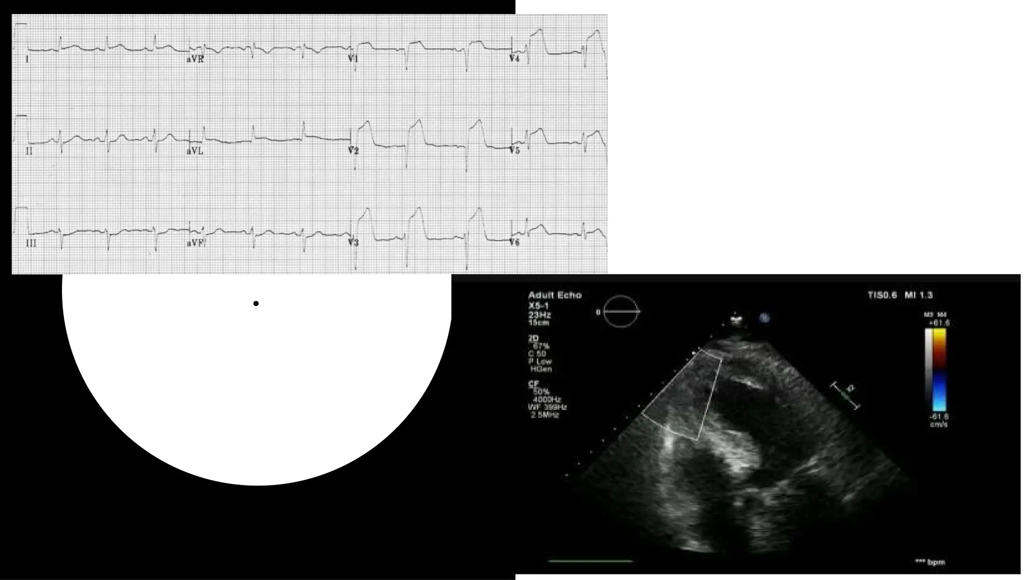 ST Elevated Myocardial Infarction (STEMI): Case Report | PPTX