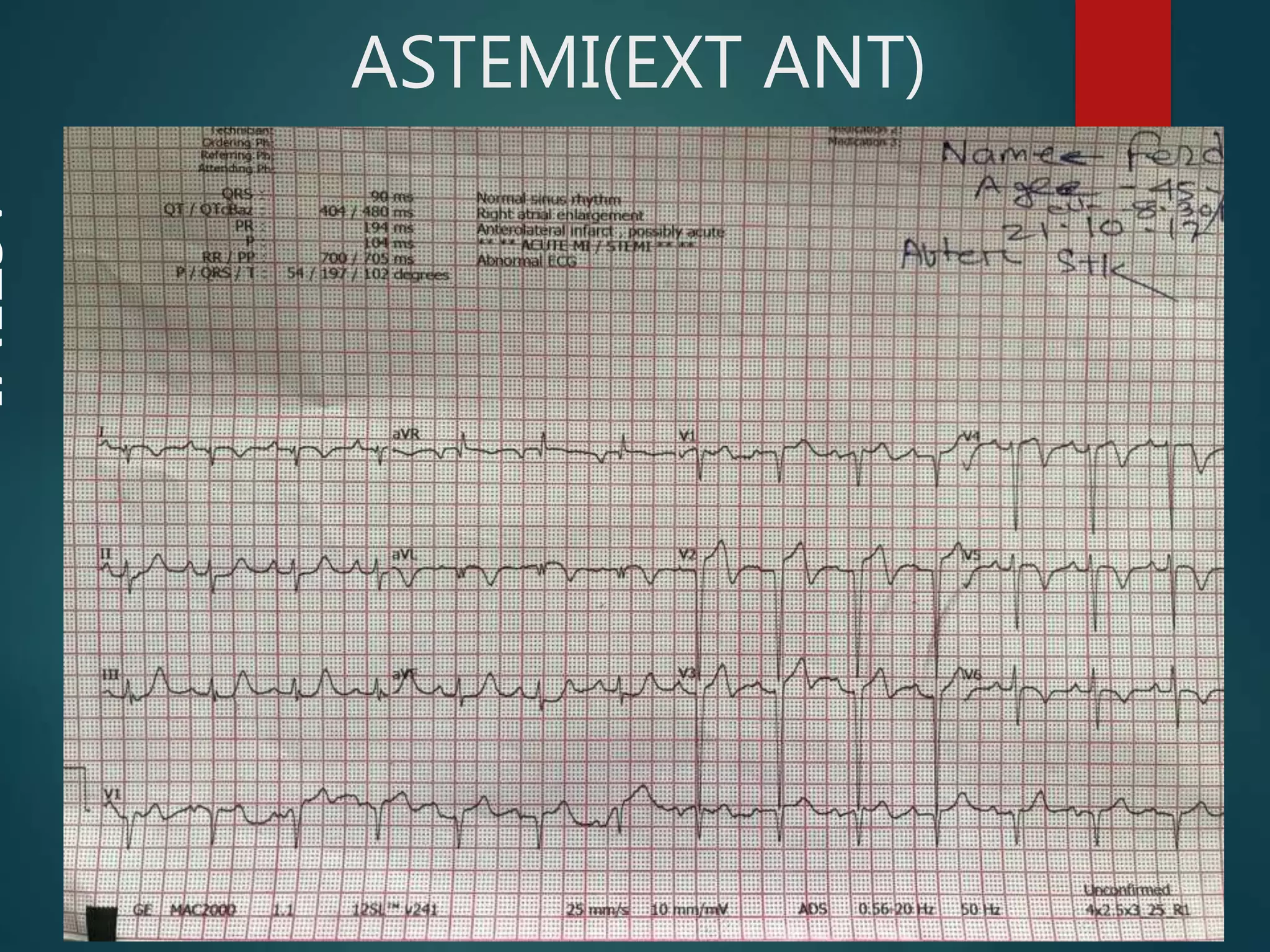 Stemi by dr.mehelina | PPTX