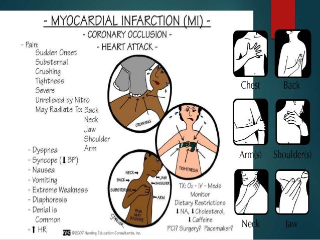 Stemi by dr.mehelina