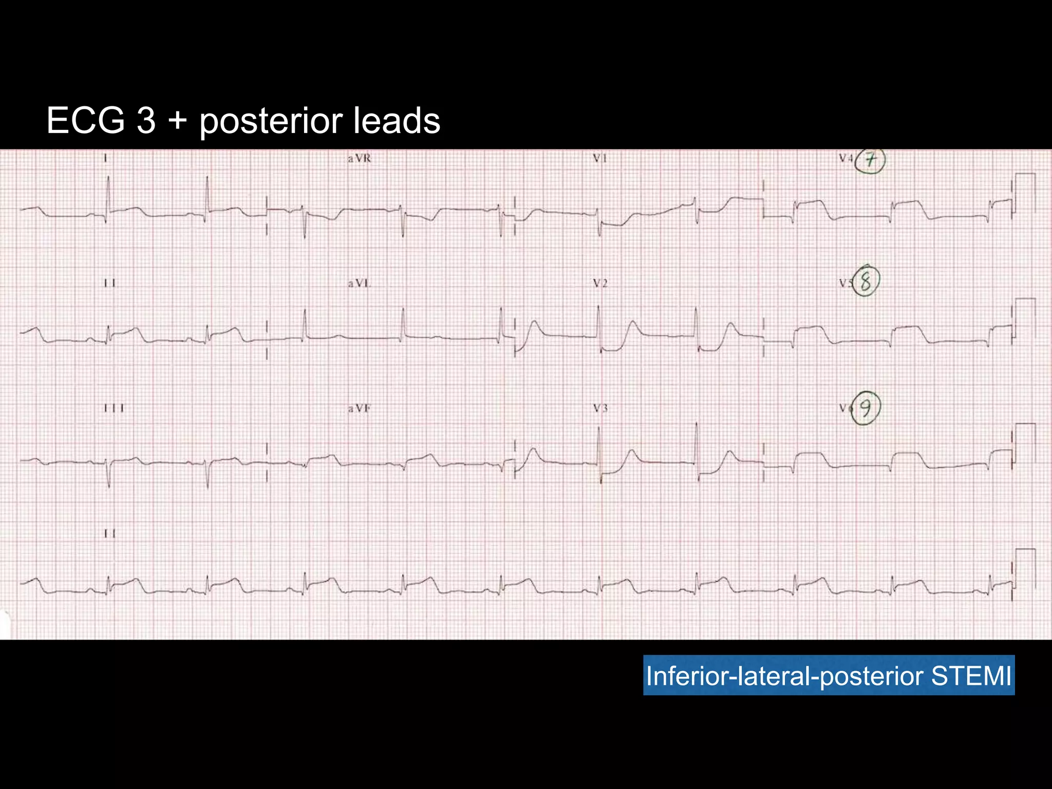 Stemi criteria | PPTX