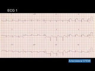 Stemi criteria | PPTX