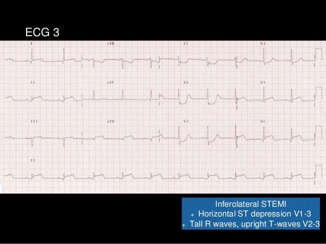 Stemi criteria
