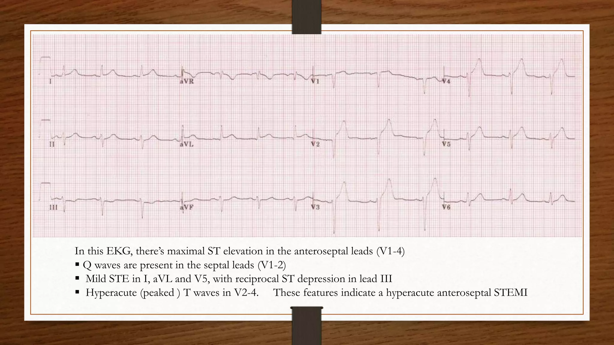 ST elevation myocardial infarction ECG signs 2 | PPT