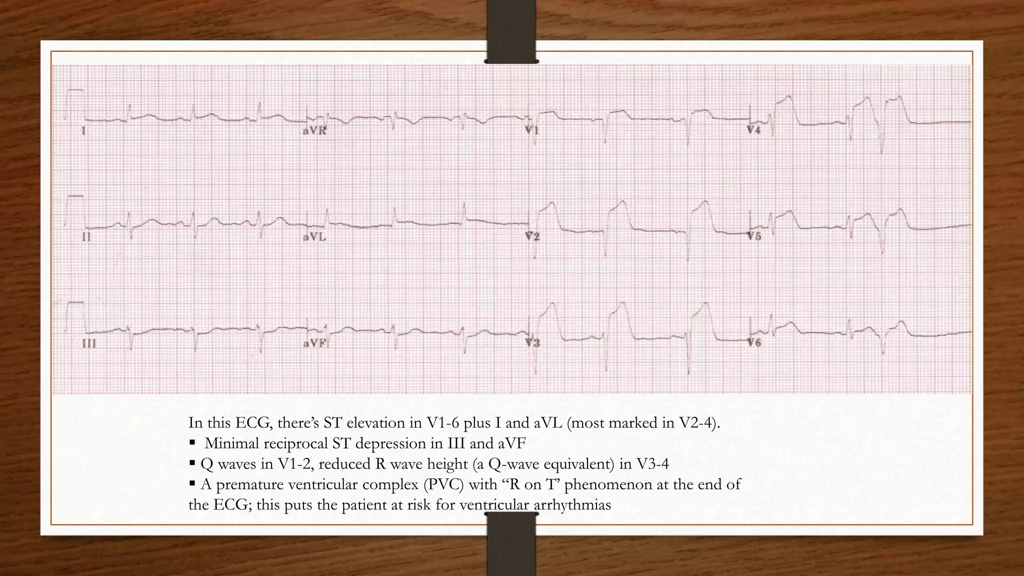 ST elevation myocardial infarction ECG signs 2 | PPTX