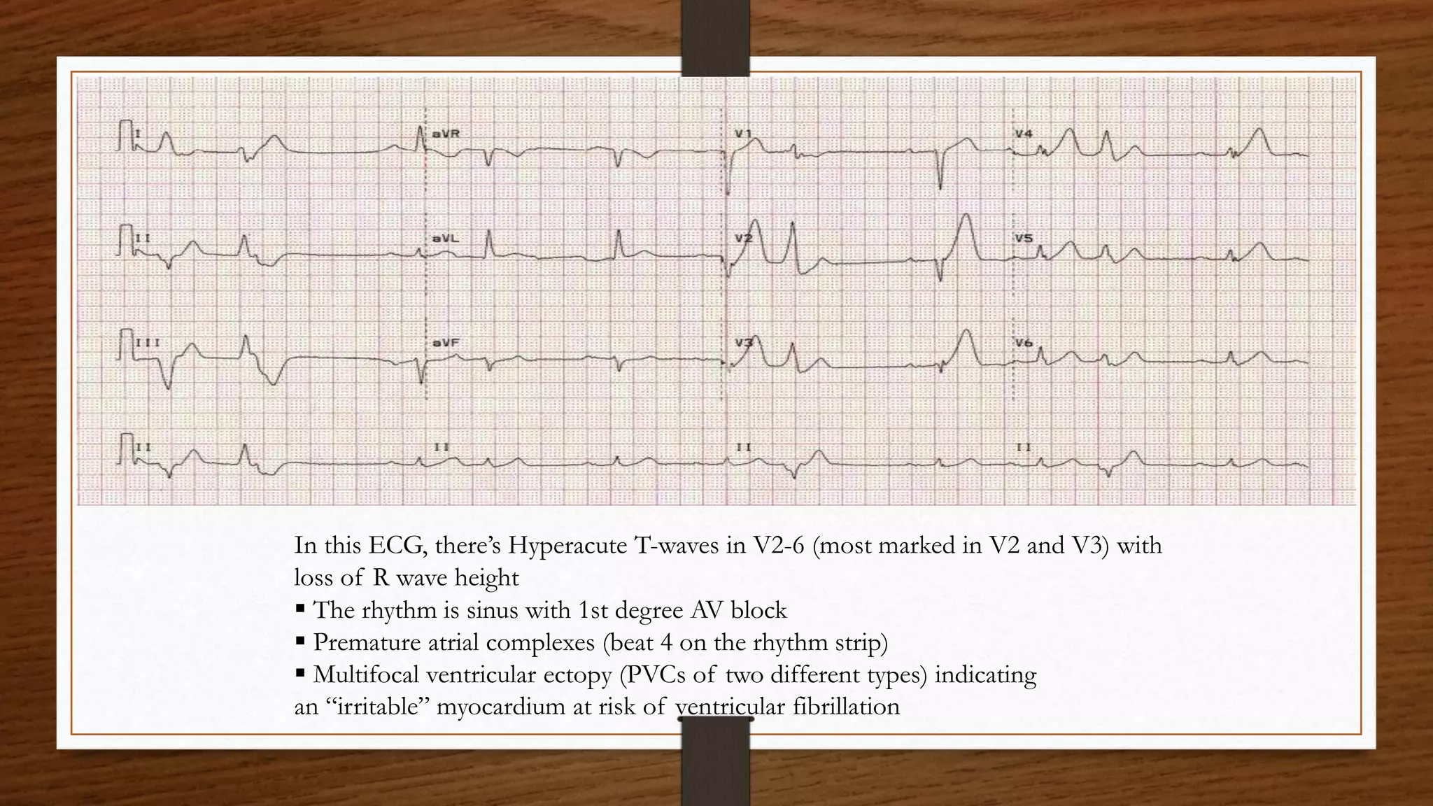 ST elevation myocardial infarction ECG signs 2 | PPT