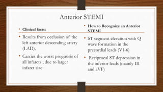 ST elevation myocardial infarction ECG signs 2 | PPT