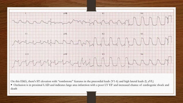 ST elevation myocardial infarction ECG signs 2 | PPT
