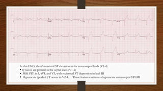 ST elevation myocardial infarction ECG signs 2 | PPT