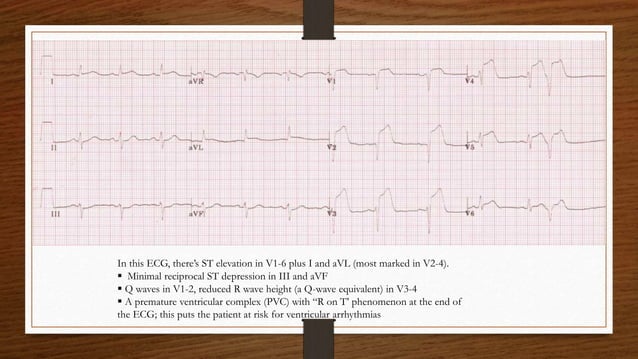 ST elevation myocardial infarction ECG signs 2 | PPT
