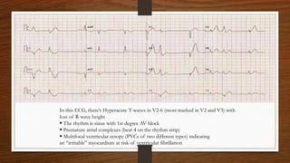 ST elevation myocardial infarction ECG signs 2 | PPT