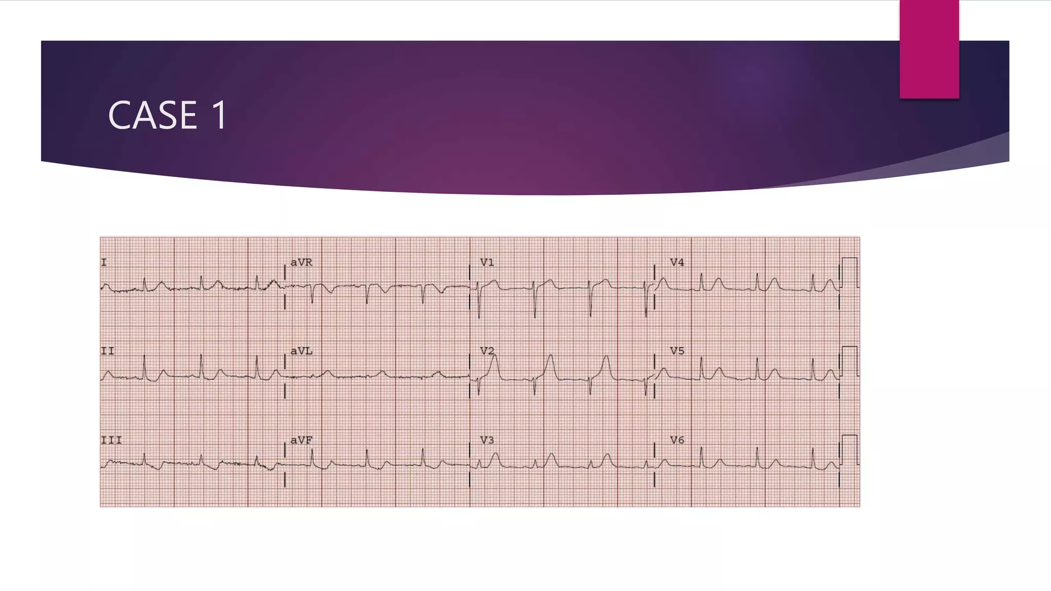 STEMI EQUIVALENT 1.pptx