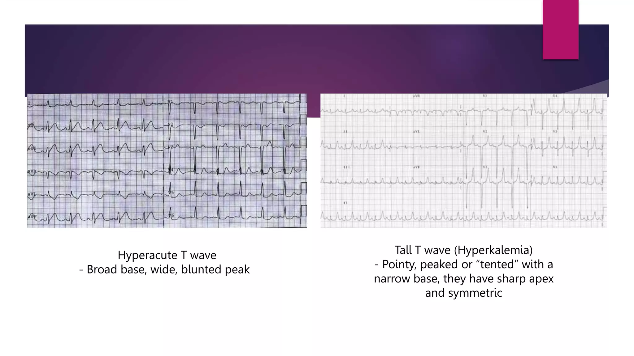 STEMI EQUIVALENT 1.pptx