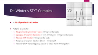 STEMI EQUIVALENT 1.pptx