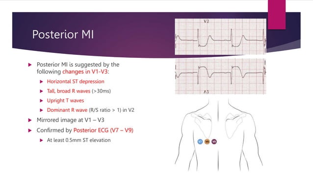 STEMI EQUIVALENT 1.pptx | Heart and Cardiovascular Diseases | Diseases ...