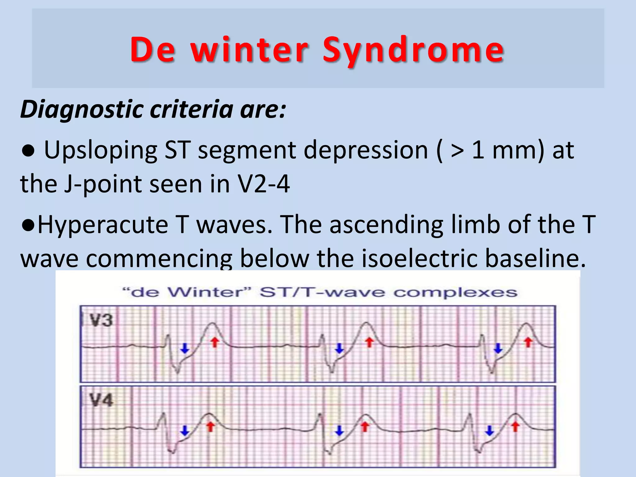 Stemi equivalents | PPTX