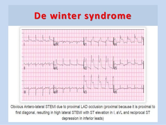 Stemi equivalents