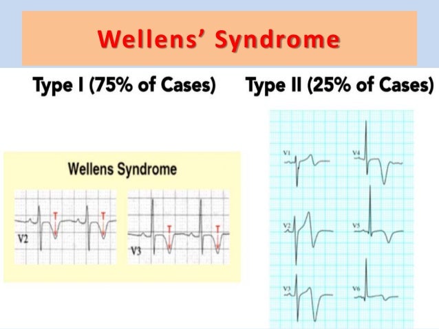 Stemi equivalents